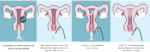 Saline Infusion Sonogram (SIS) - Generation Next Fertility