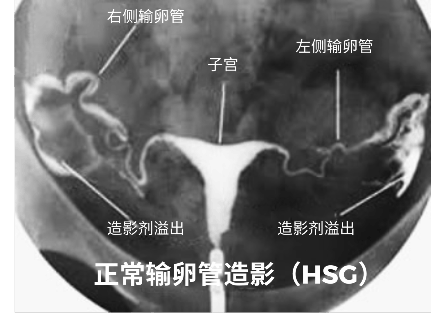 Fallopian Tube Testing - Generation Next Fertility