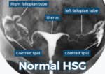 Hysterosalpingogram (HSG) - Generation Next Fertility
