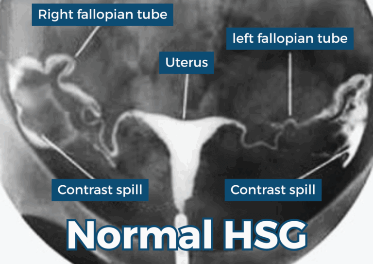 Hysterosalpingogram (HSG) - Generation Next Fertility